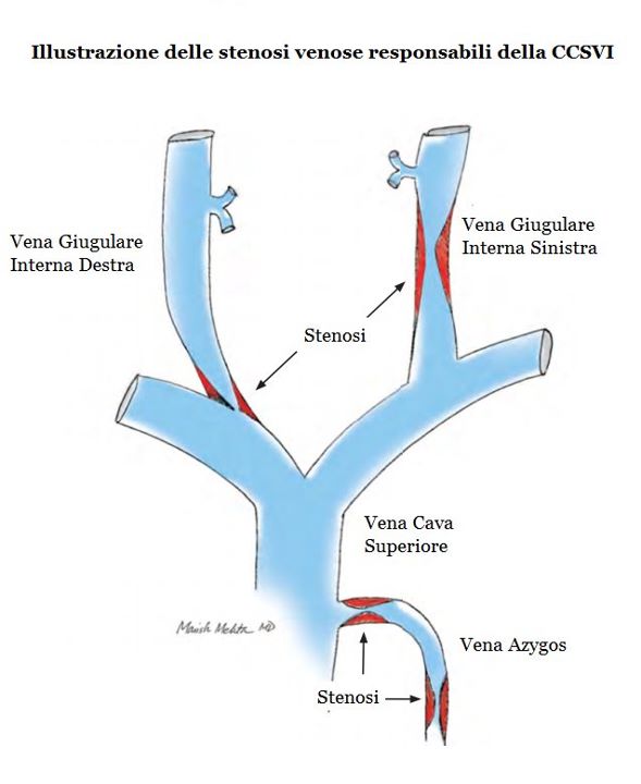 la Sclerosi multipla .. Ccsvi vista da SAM, e NON solo: ccsvi...... e ...