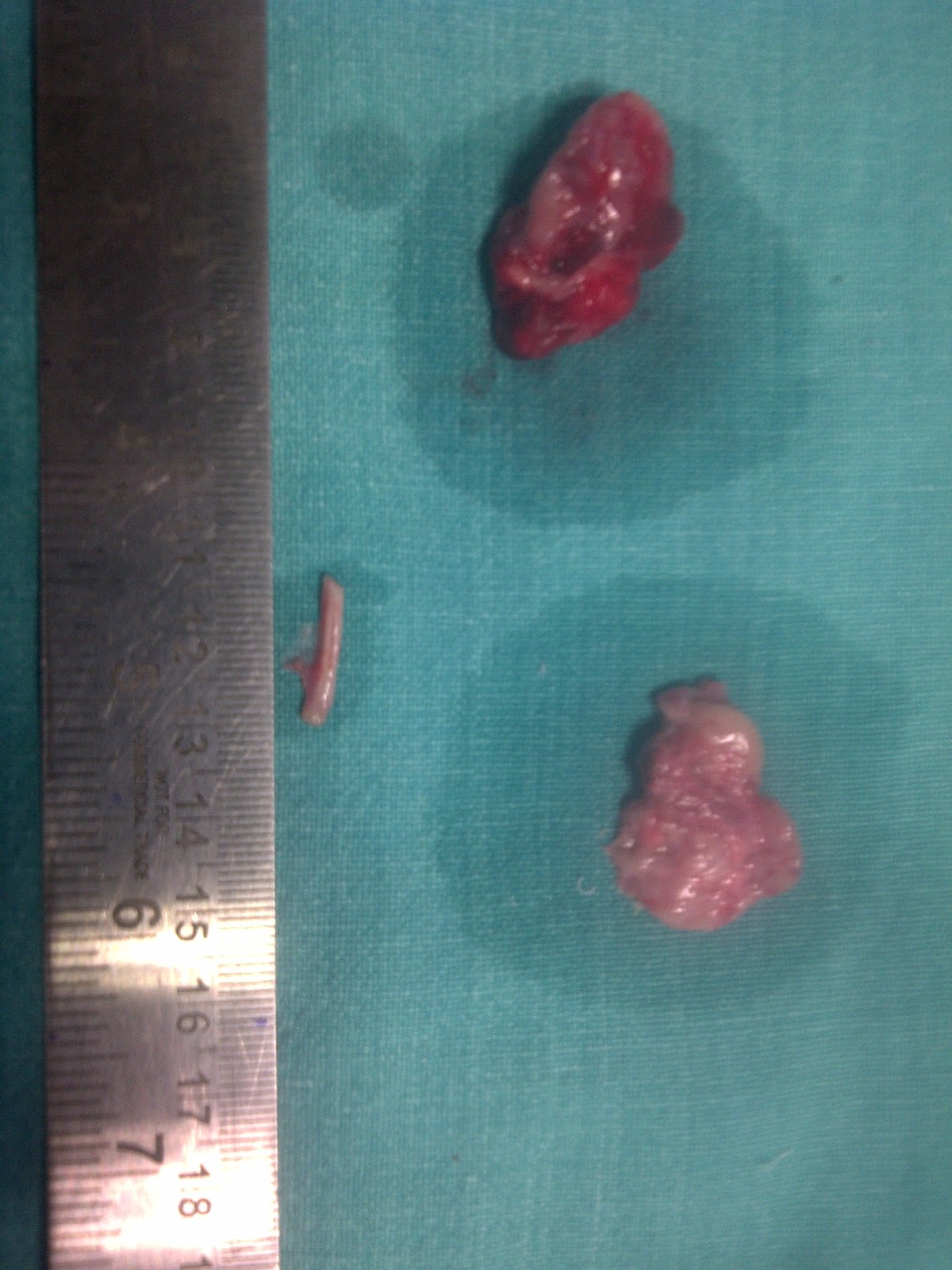 ENT Surgeon's blog: Elongated Styloid Process Excision