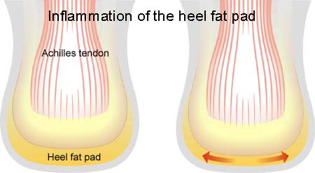 NHWC Media Blog: Heel Fat Pad Syndrome