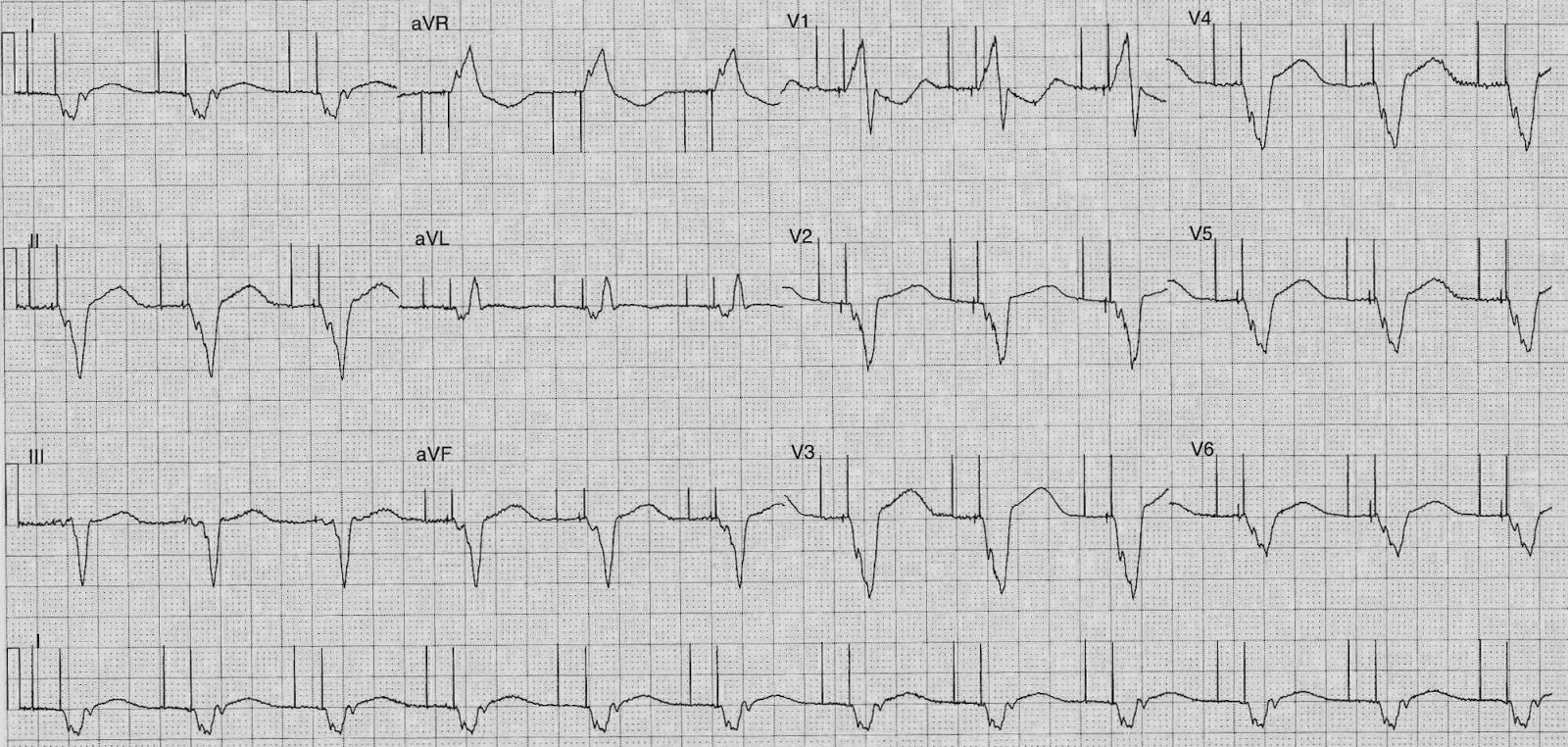 ECG of the Week: ECG of the Week - 2nd June 2014 - Interpretation
