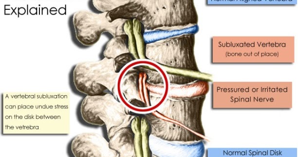The Subluxation Station: What the hell is a "subluxation"?