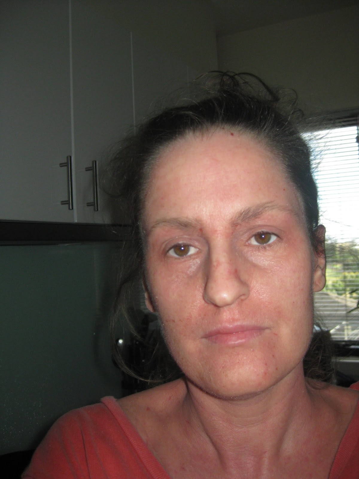 Topical Steroid Withdrawal Journey-Healing Eczema and Red Skin Syndrome ...