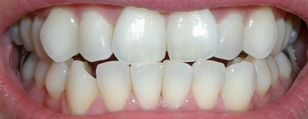 Sneek's Invisalign Treatment: Progress Weeks 3-4