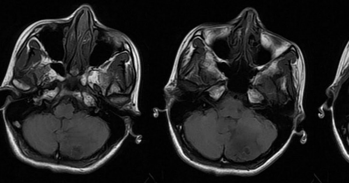 Dr Balaji Anvekar FRCR: Cerebellar avid enhancing nodule on MRI
