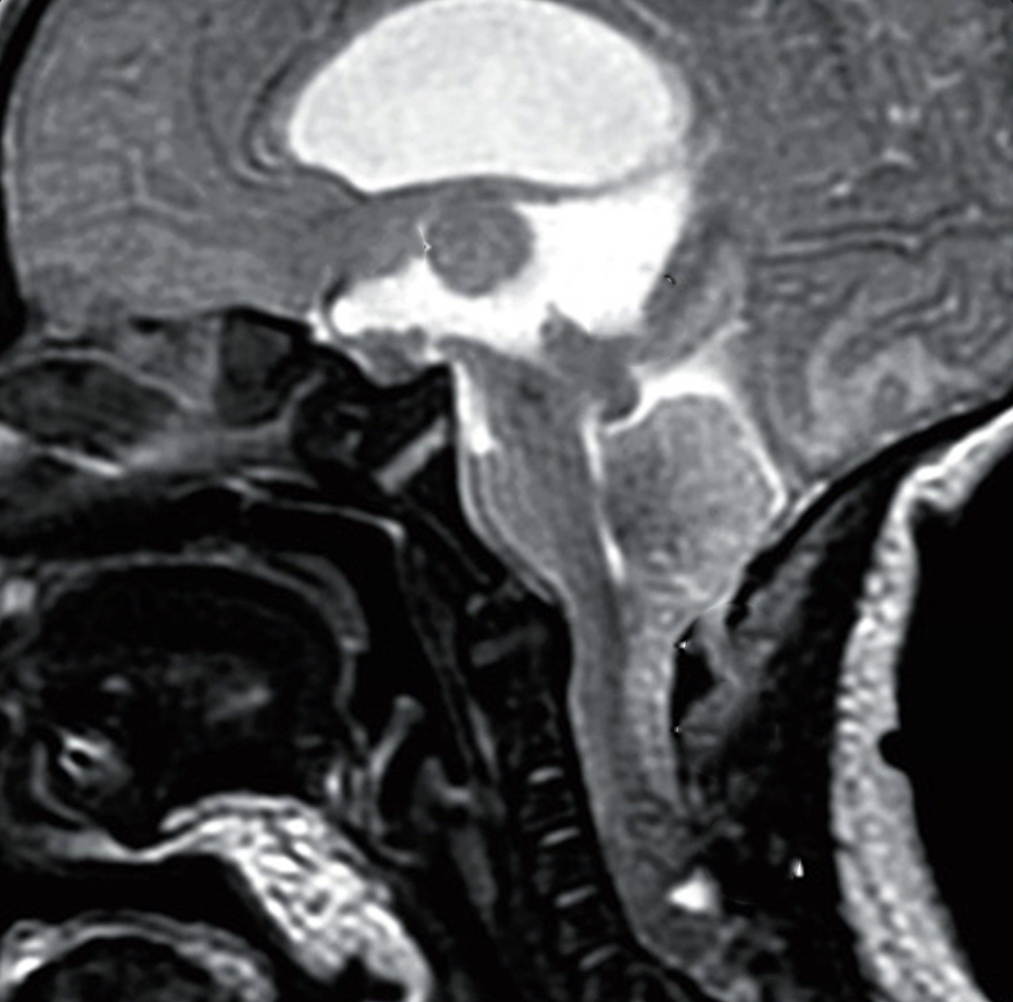 Chiari 2 malformation