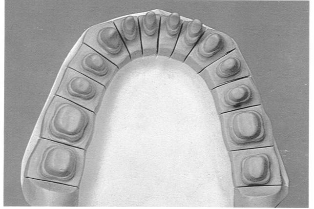 PROTESIS FIJA METAL: PROTESIS FIJA