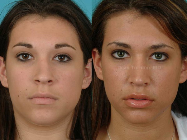 Dr. Dean Toriumi Reviews: Dr. Toriumi's operation to correct the ...