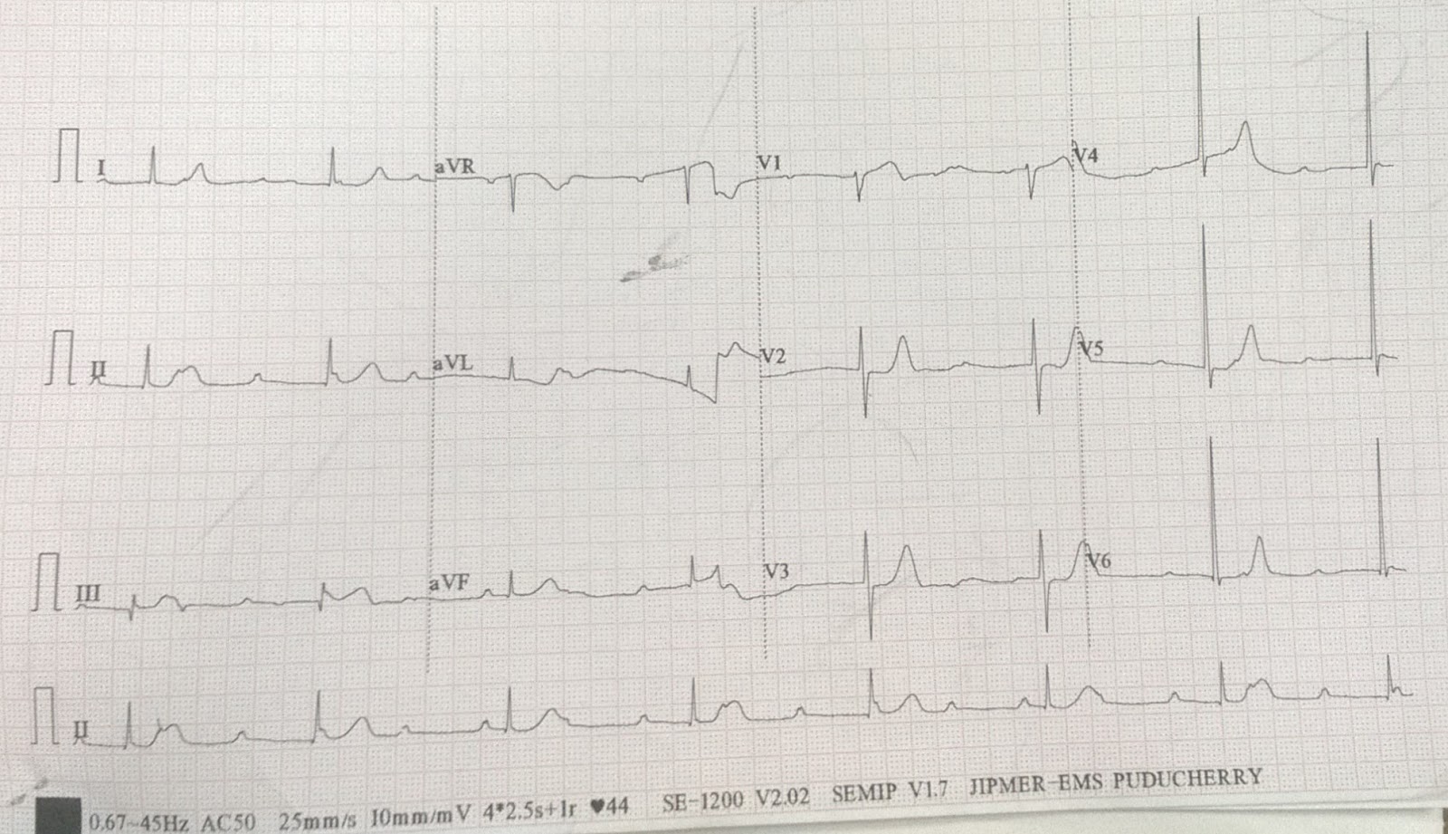 Cardiology window: Inferior wall myocardial infarction presenting as ...