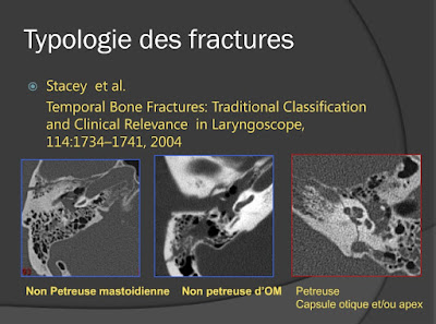 Ma bibliothèque en Imagerie Médicale: FRACTURE DU ROCHER