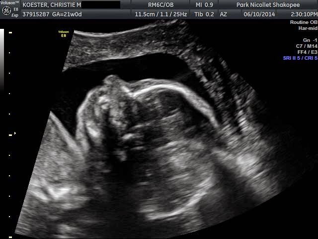20 Week Level II Ultrasound - Baby #2 ~ Christie Koester