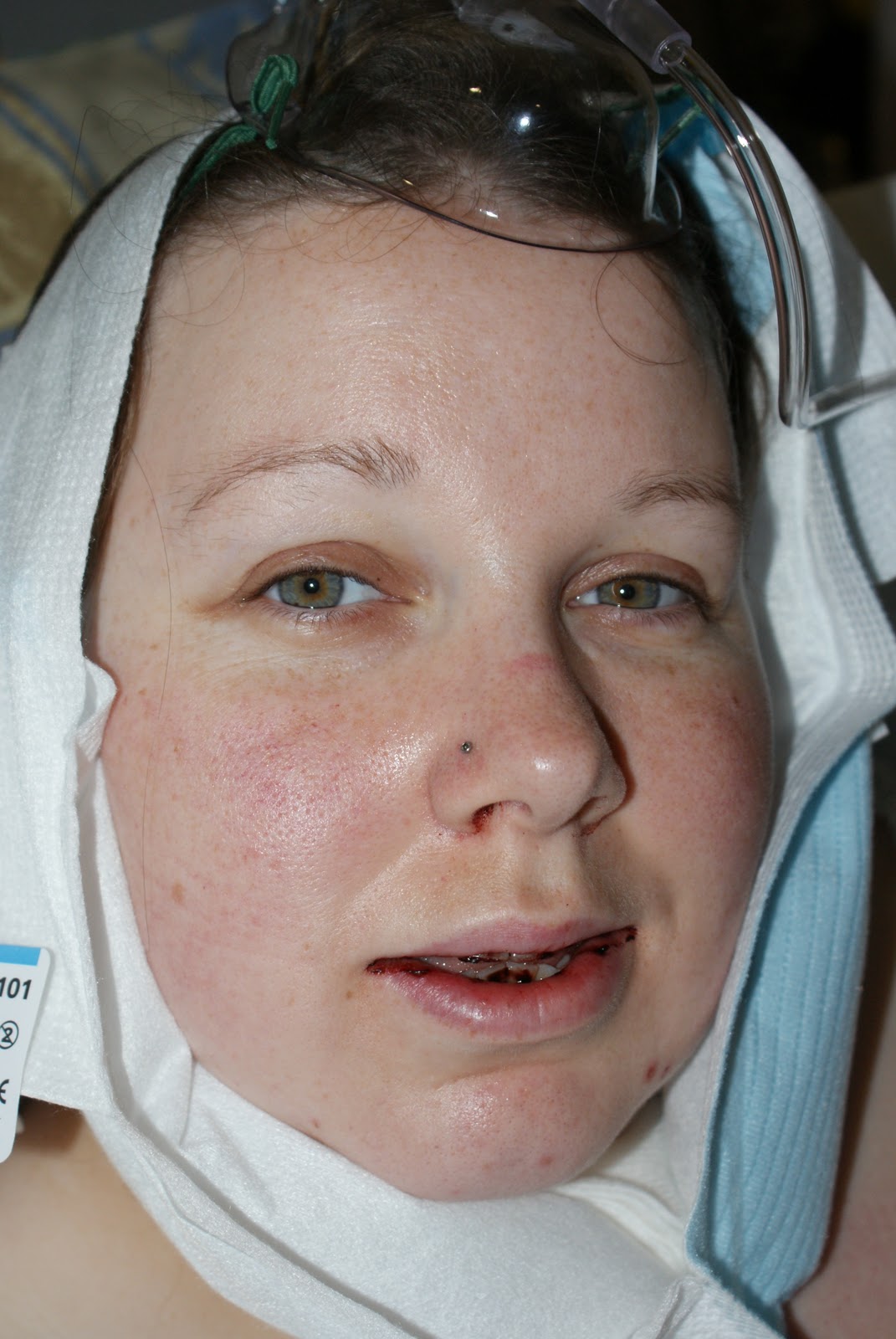 Braces + SARPE/SARME Surgery: SARPE/SARME Surgery