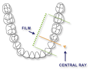 Dentistry and Medicine: Intraoral Radiographic Techniques (Paralleling ...