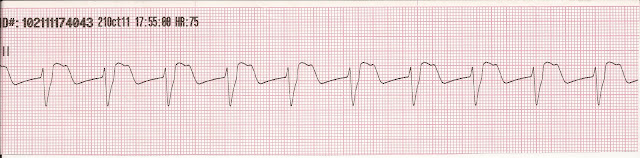 Basic ECG Rhythms