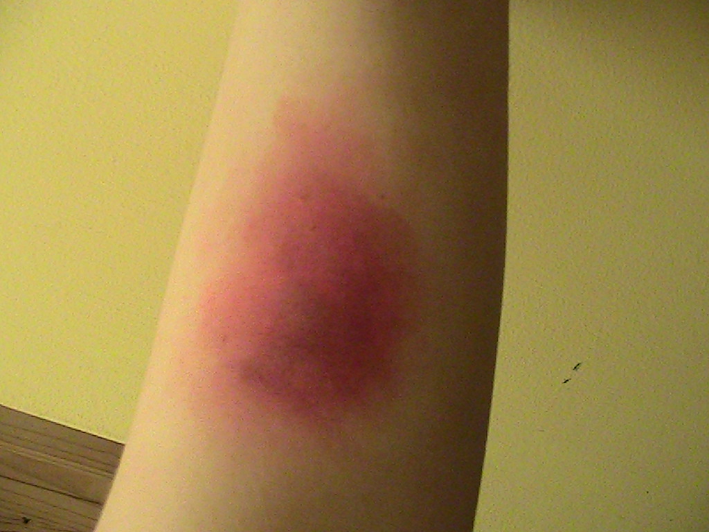 Penance: Fake Bruise Experimentation