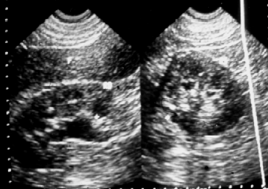 ecografie imagini medicina renal Renal nativ Hidronefroza | Terapii ...