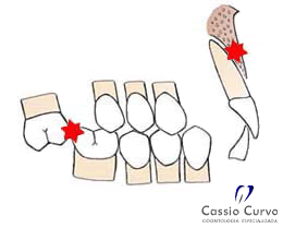 Orientações sobre Oclusão: Trauma Oclusal e por escova de dentes