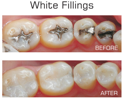 The Windsor Dental Blog: White Fillings Vs Silver Fillings