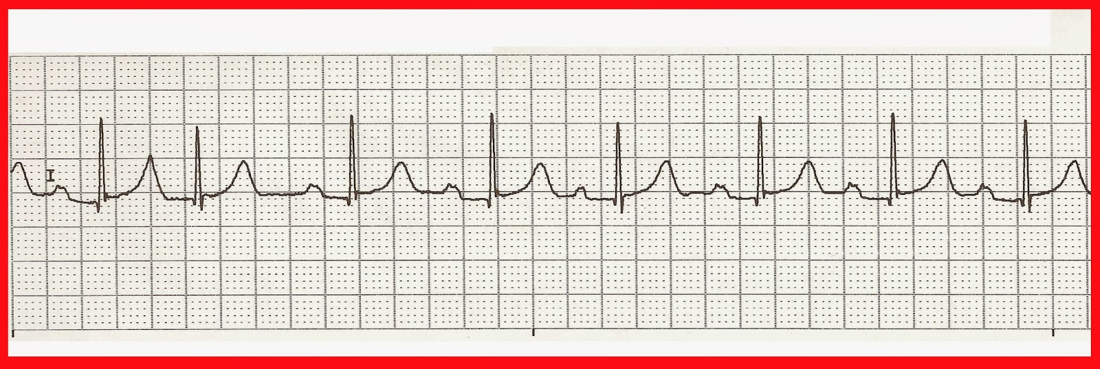 Practice EKG Rhythm Strips 232