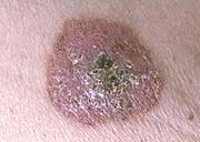 Bessie-bessi: Basalcellscancer