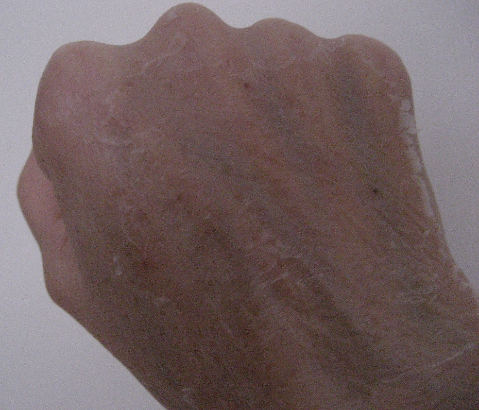 Chemical Peels for Acne and Anti Aging: Hands Really Tell Our Age ...