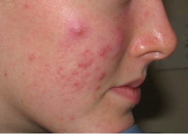Severe Cystic Acne Treatment Options ~ Health Safety Tips