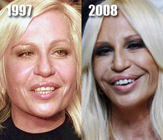 Donatella Versace Plastic Surgery Before and After Nose Job, Facelift ...