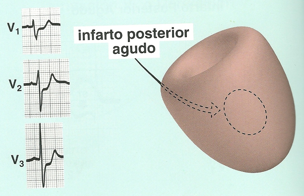 Dr. Rafael Soto - Electrocardiografía - Cardiología clínica: Infarto ...