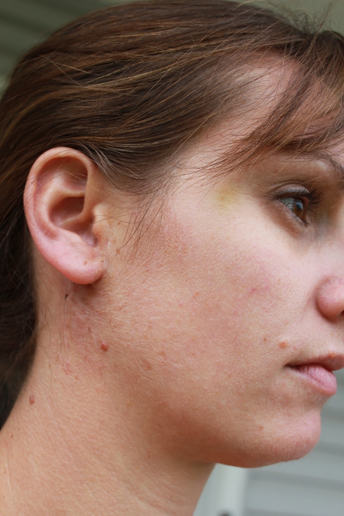 I've got a what? The journey of a parotid tumor.: Parotid surgery ...