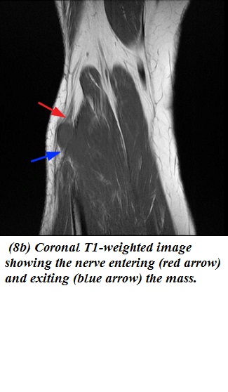 MRI Musculo-Skeletal Section: Common Peroneal Nerve Abnormalities