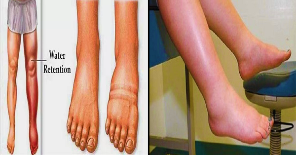 Health Medicine: 6 THINGS THAT CAUSE FLUID RETENTION IN YOUR BODY AND ...