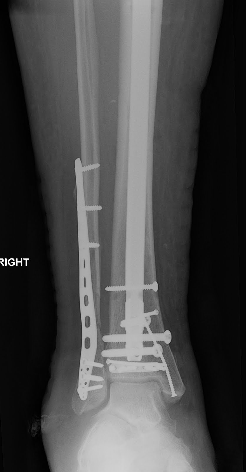 Case of the Month: Fracture cases at Harborview Medical Center ...