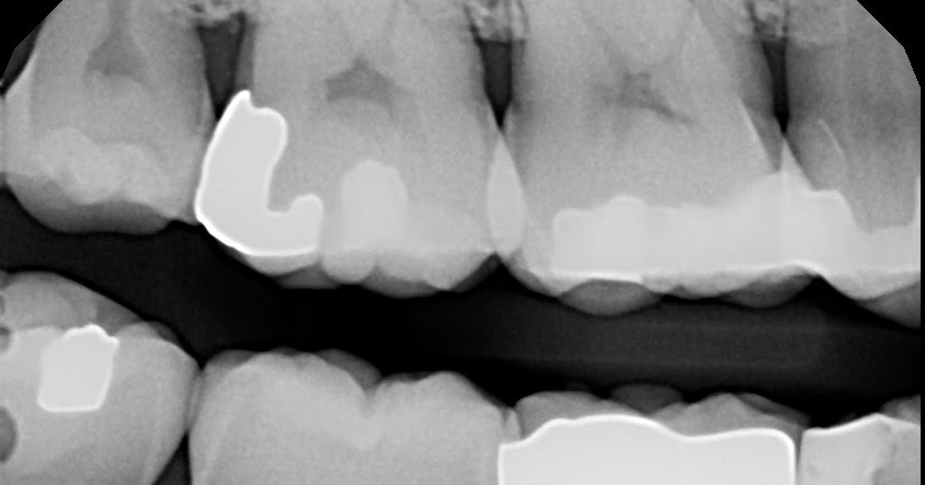 Dental Info: How to perform the sandwich technique for performing Class ...