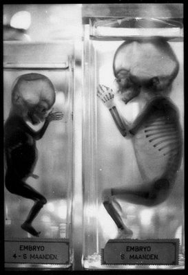 PictoVista: World’s Most Disturbing Bottle Babies in The Mütter Museum ...