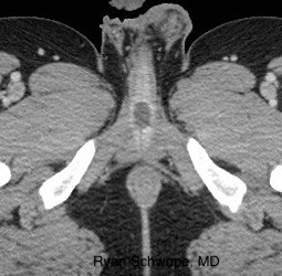 Roentgen Ray Reader: Cowpers duct syringocele