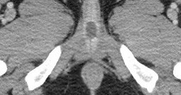 Roentgen Ray Reader: Cowpers duct syringocele
