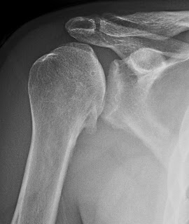 UW Shoulder and Elbow Academy: Shoulder joint replacement - many ...
