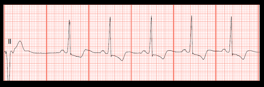 Practice EKG Strips 372