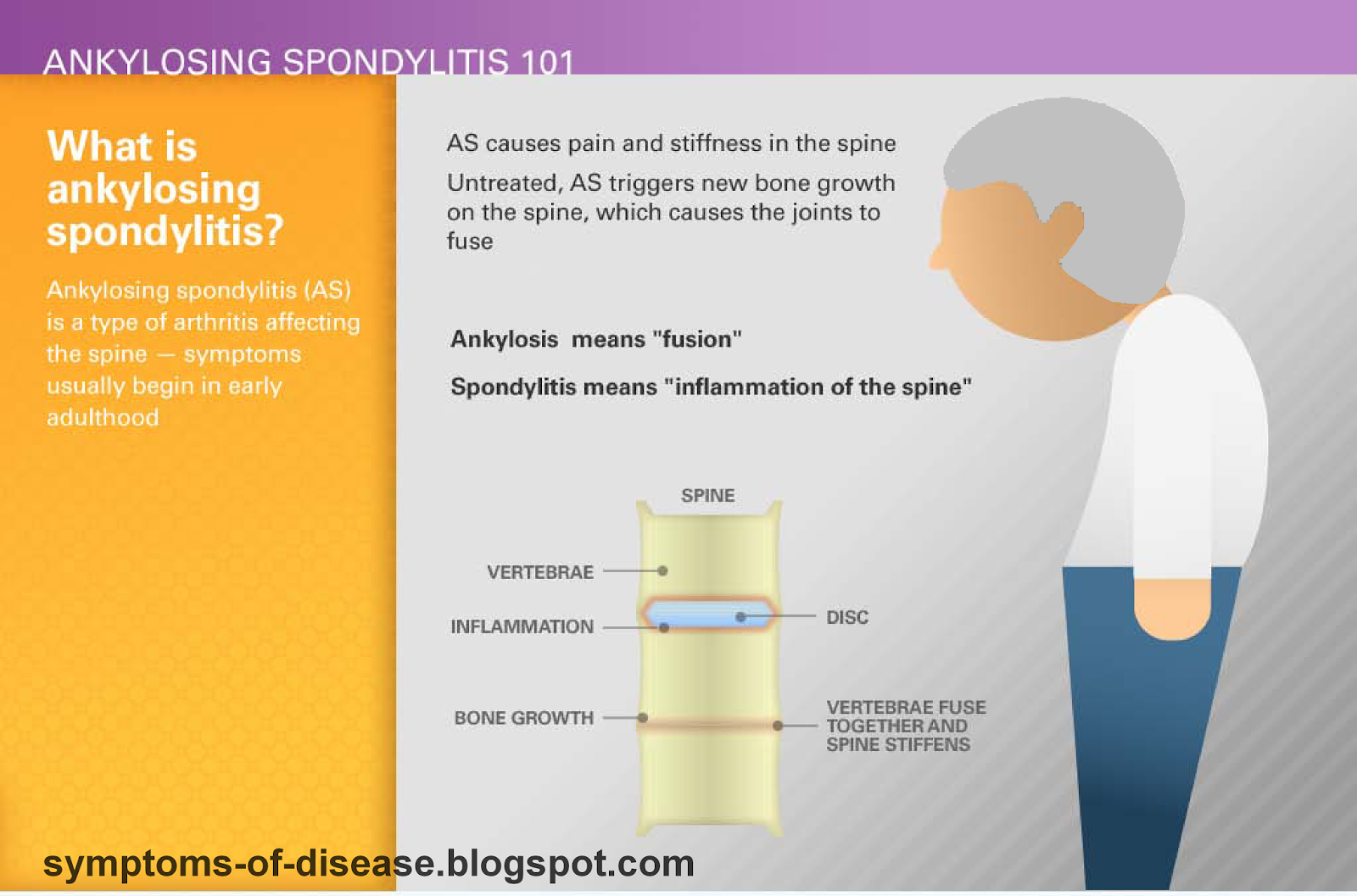 Ankylosing Spondylitis Symptoms Symptoms Of Disease