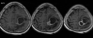 Dr Balaji Anvekar FRCR: Pyogenic Abscess MRI
