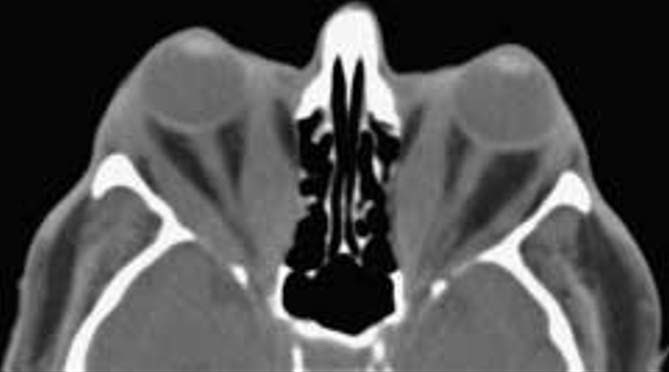 docteur: Orbitopathie endocrinienne d’origine thyroïdienne