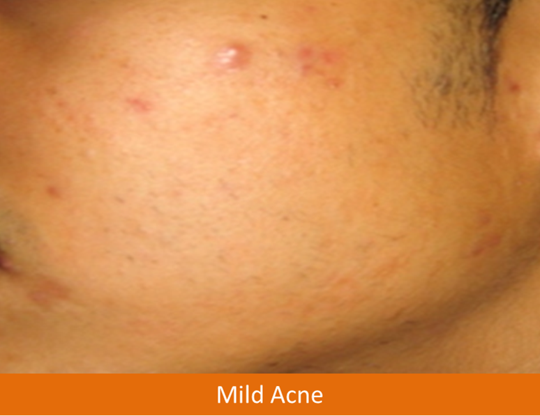 November 2014 ~ Acne Slayer