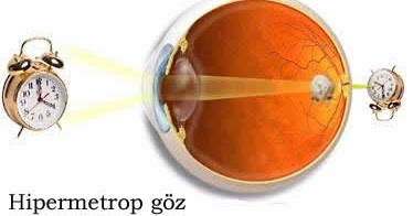 Gambar Mata Hipermetropi / Pengertian dan Macam-Macam Penyakit Gangguan ...