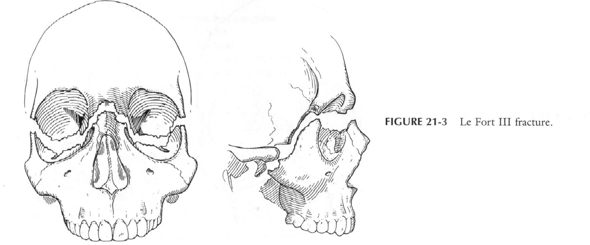 Slamet: ASKEP TRAUMA WAJAH