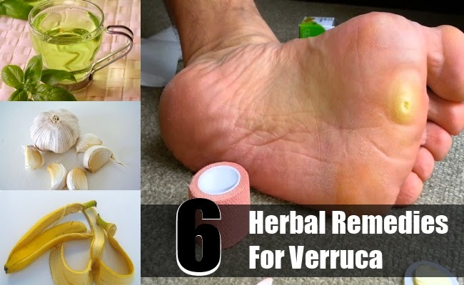 6 EFFECTIVE HERBAL REMEDIES FOR VERRUCA ~ Mzizi Mkavu