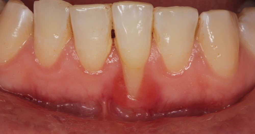 Gingival Recession: Its Symptoms Treatments And Prevention
