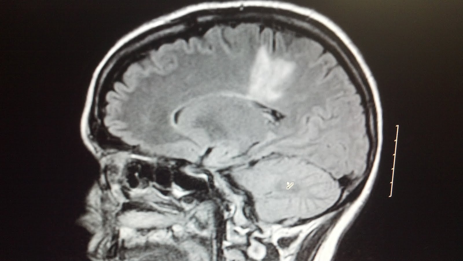 Tumefactive Multiple Sclerosis: MRI pics January