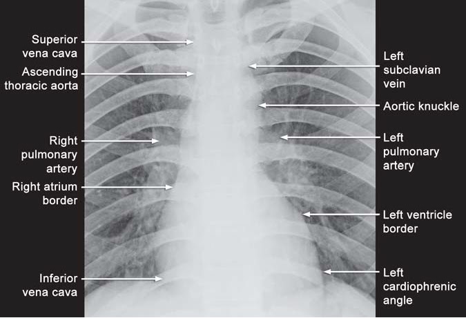 Study Medical Photos: Simplified Approach To Reading Chest X- Rays.