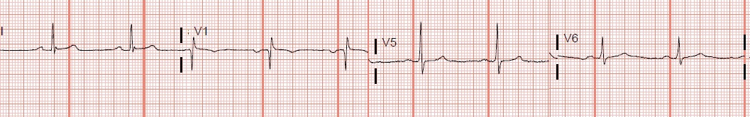 Bundle Branch Block Quiz Part 2