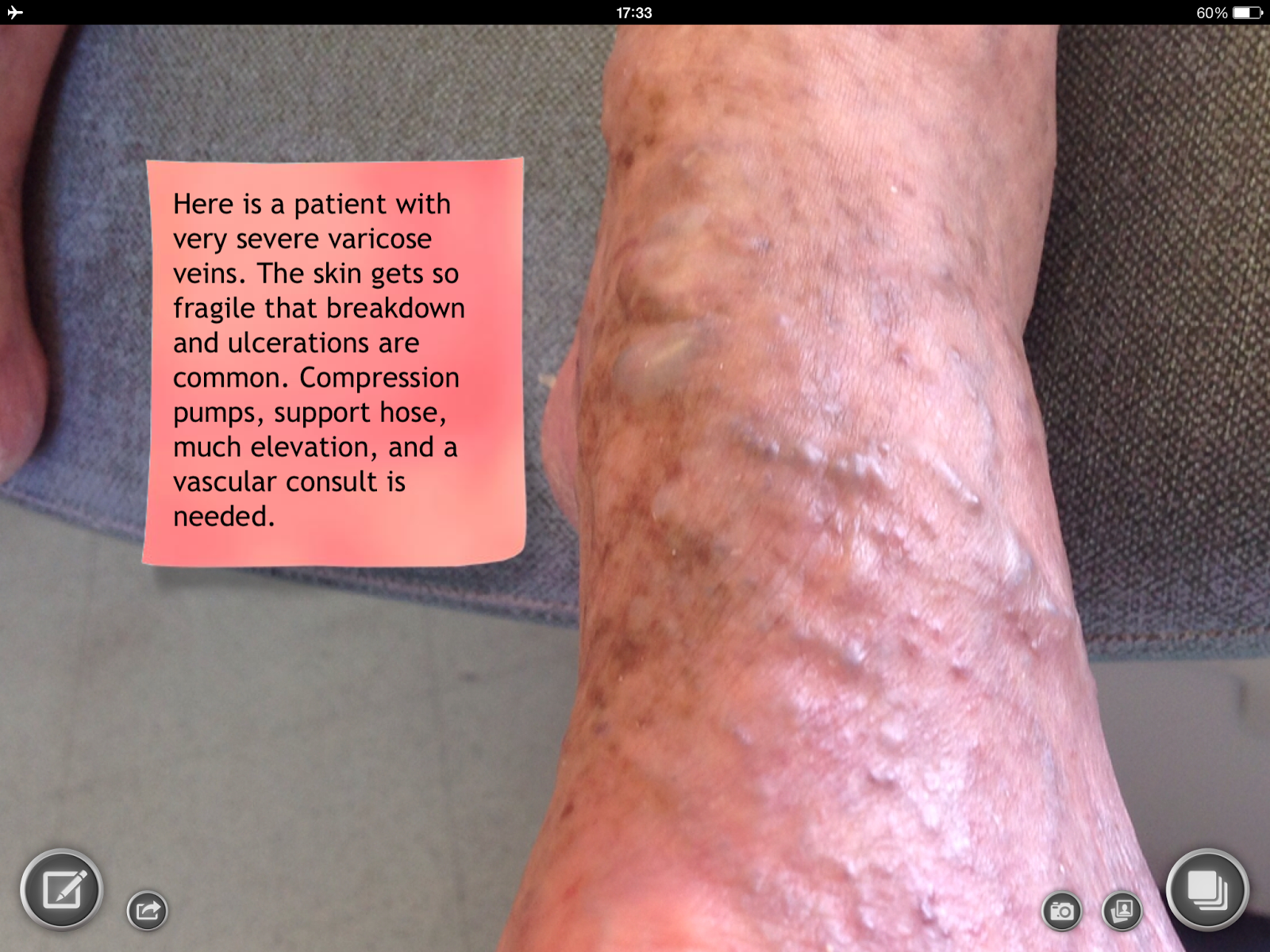 Foot And Ankle Problems By Dr Richard Blake Varicose Vein Photo