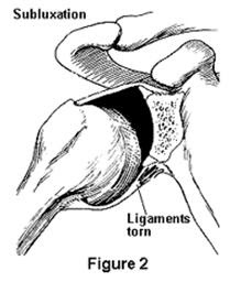 The Role of NMES in the Rehabilitation of the Upper Limb Post Stroke ...